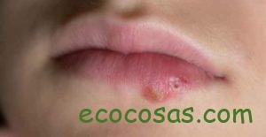 Herpes labial: qué es, por qué sale. Cuáles son los síntomas